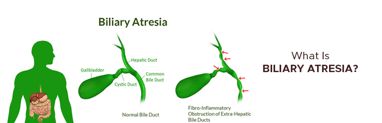 Know about Biliary Atresia: A Rare Disease that Affects Children