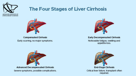 Understanding The Four Stages Of Liver Cirrhosis